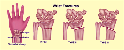 Osteoporosis - Causes, Signs and its Symptoms