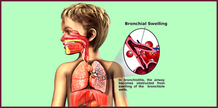 Lung Diseases – Types, Causes, and their Symptoms