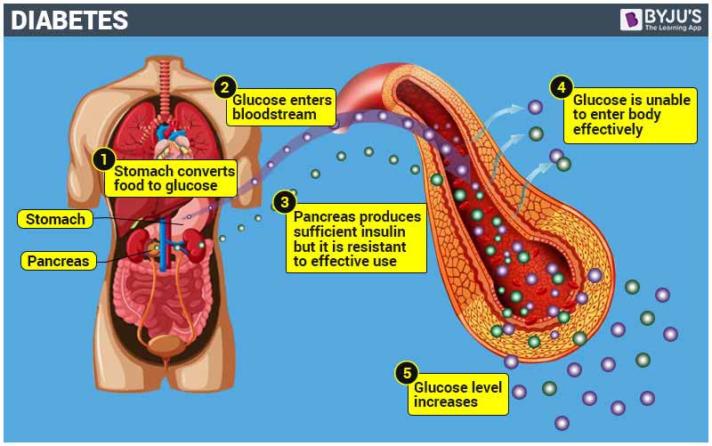 Diabetes Mellitus Symptoms Treatment Type 1 Diabetes Type 2 Diabetes