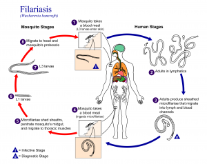 Filariasis Elephantiasis- Types, Symptoms, Causes & Treatment