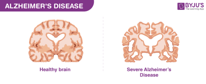 Nervous System Diseases - An Overview, Types and their Symptoms