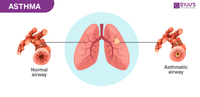 Asthma - Symptoms, Causes, Diagnosis, Types & Treatment