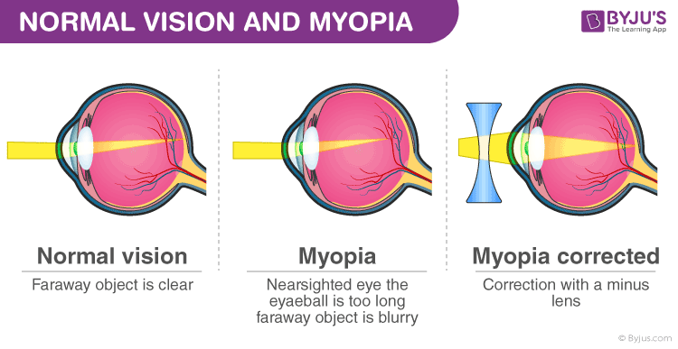 Eye Defects Myopia Its Causes Symptoms And Treatment Eye Defects Myopia Its Causes Symptoms And Treatment