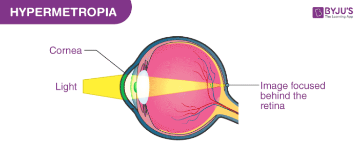 Hypermetropia - Far-sightedness - Symptoms, Causes, Types and Treatment
