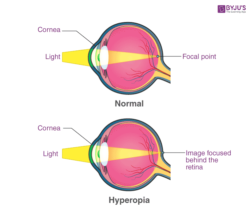 Hypermetropia - Far-sightedness - Symptoms, Causes, Types and Treatment